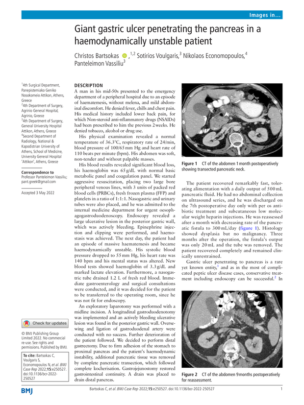 Giant gastric ulcer penetrating the pancreas in a haemodynamically ...