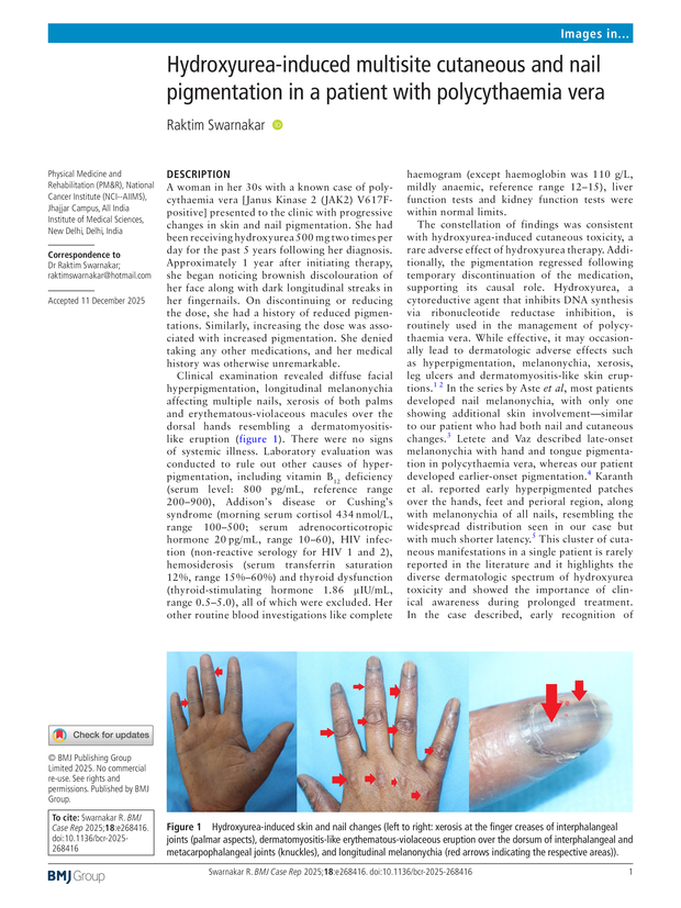Hydroxyurea-induced multisite cutaneous and nail pigmentation in a ...