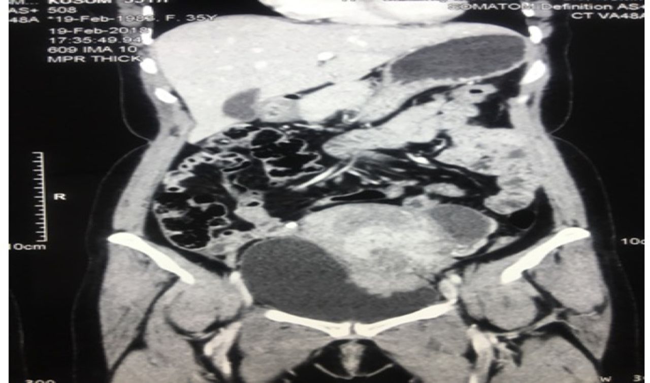 Deep infiltrating endometriosis of the uterus involving the urinary ...