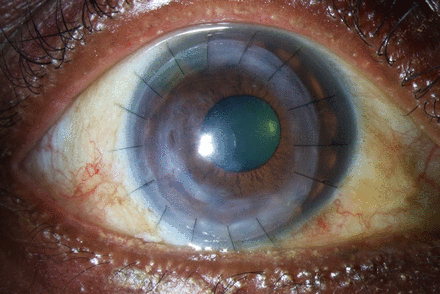 Peripheral ulcerative keratitis with corneal melt as the primary ...
