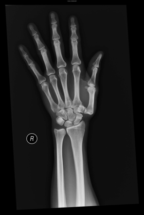 Isolated first carpometacarpal joint dislocation managed with closed ...