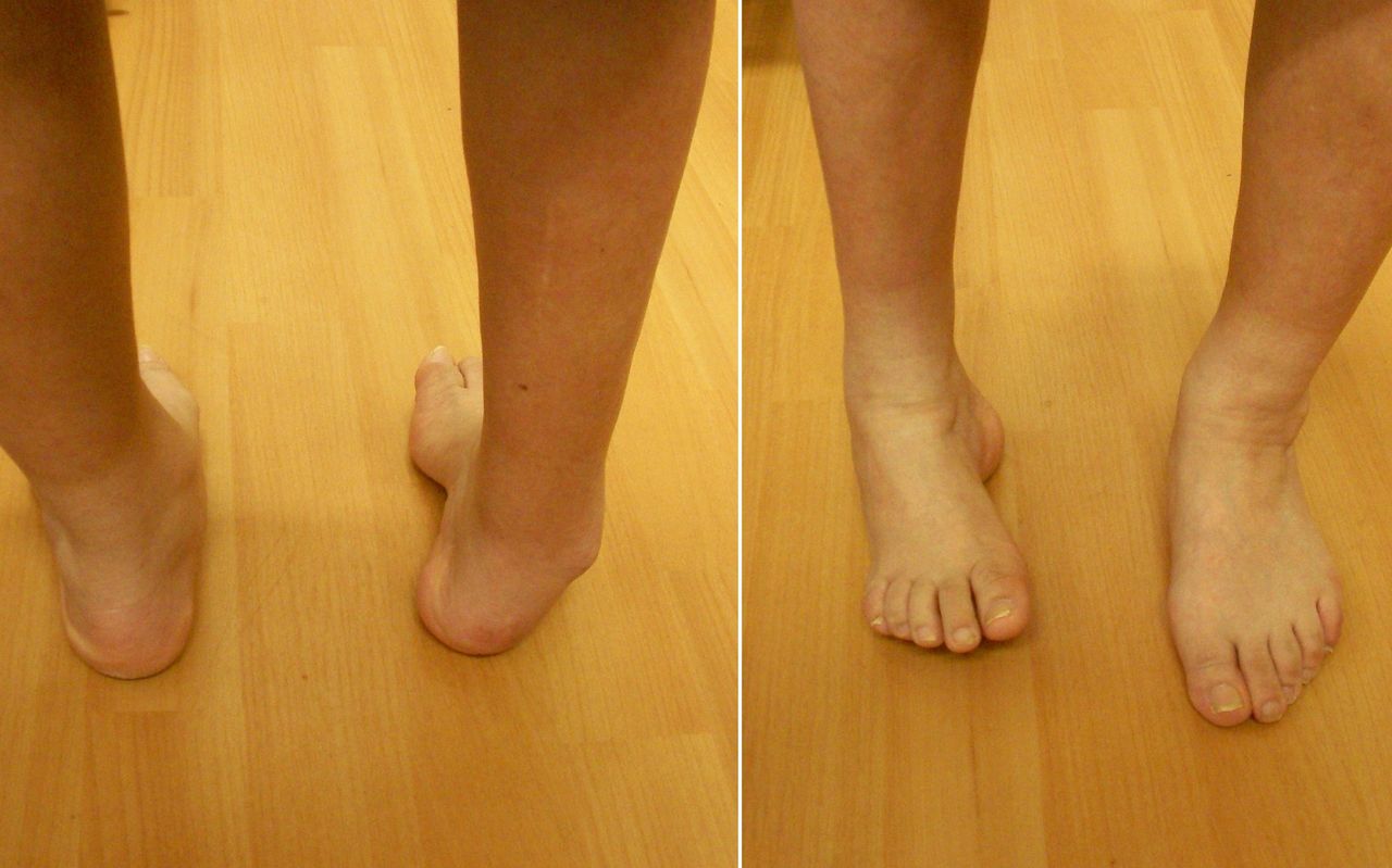 Simple semi-permanent blockade against rigid varus foot in a case with ...