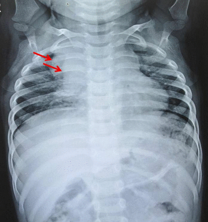 An unusual cause of lymphadenopathy in a child | BMJ Case Reports