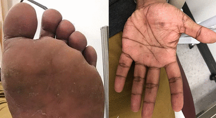 Do not miss secondary syphilis: examine the palms and soles | BMJ Case ...