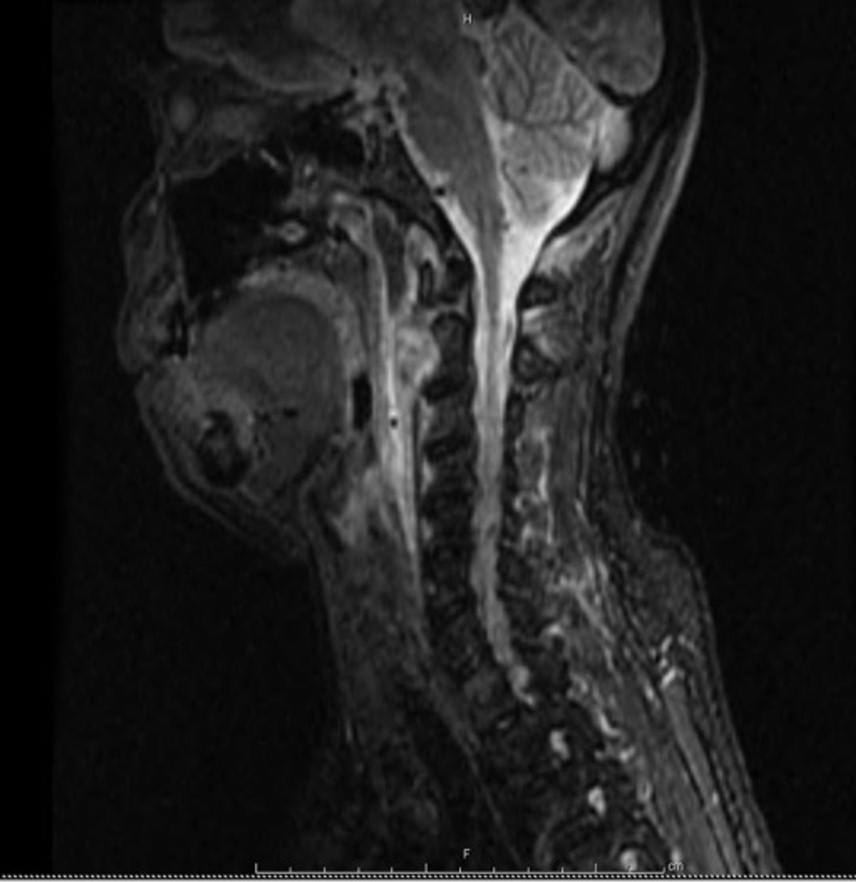 Deep neck cellulitis: a challenging diagnosis | BMJ Case Reports