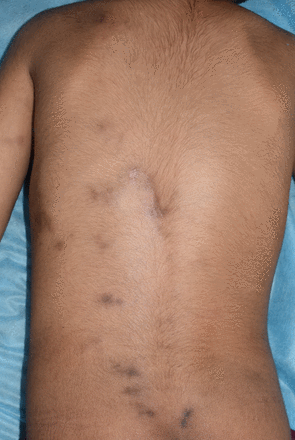 Unilateral Blaschko-linear eruption with Gottron-like papules ...