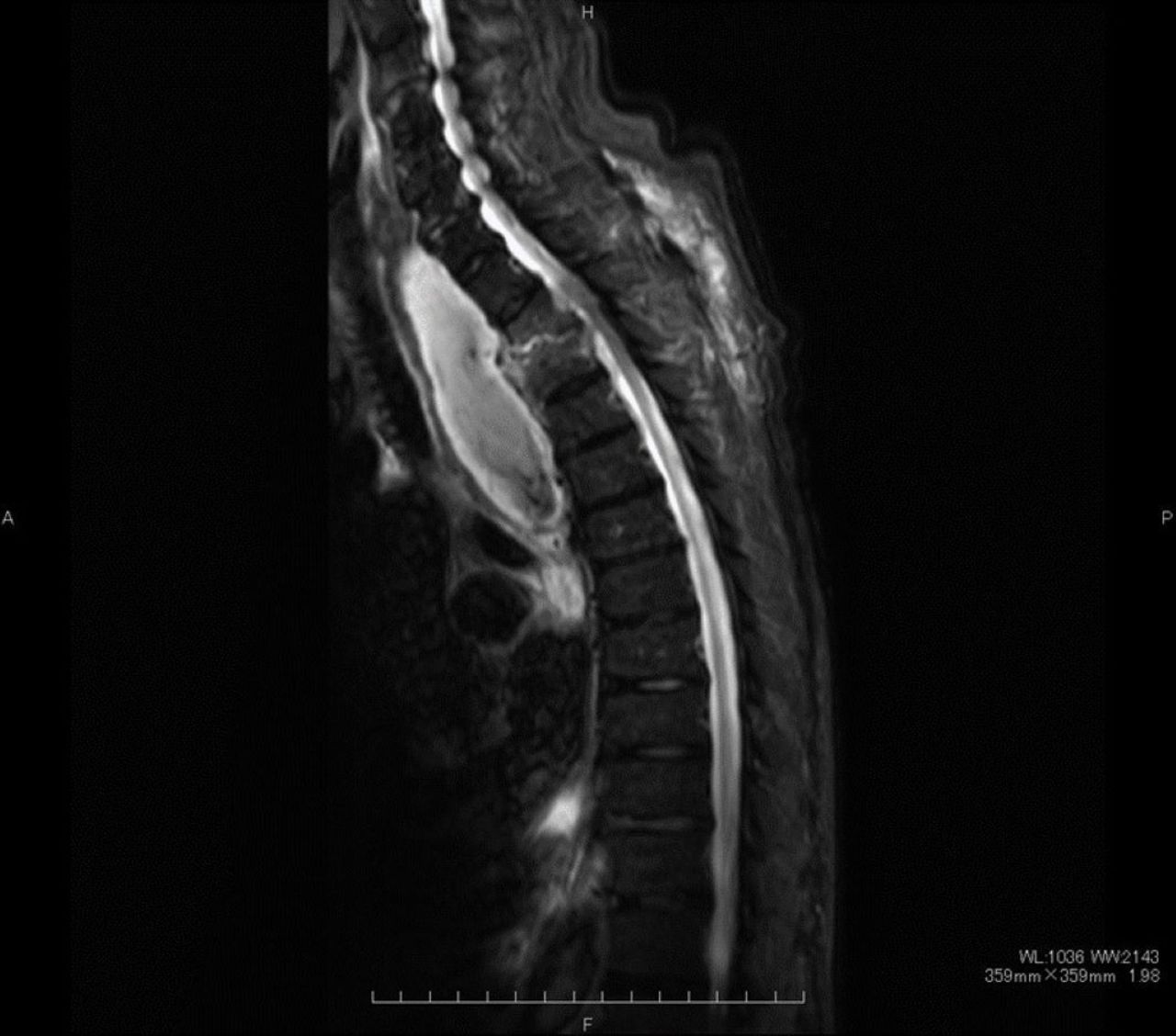 Untreated vertebral osteomyelitis extending to the mediastinum and ...