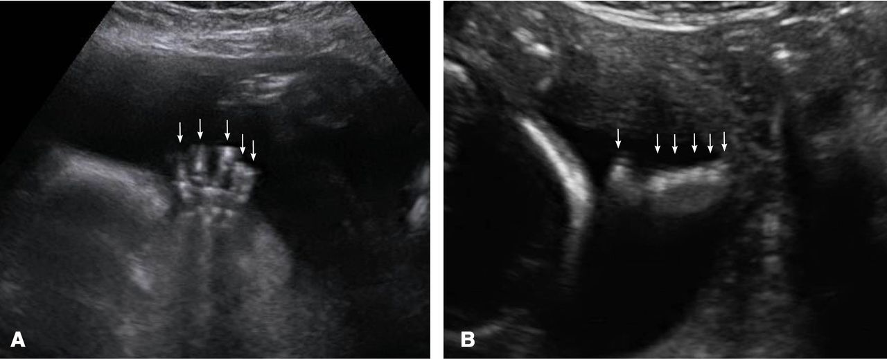 Prenatal diagnosis of Bardet-Biedl syndrome: a multidisciplinary ...
