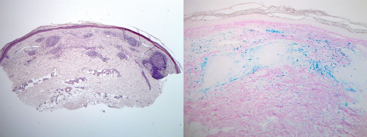 Granulomatous pigmented purpuric dermatosis | BMJ Case Reports