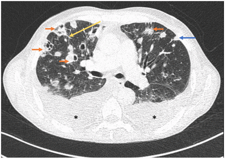 Septic pulmonary embolism | BMJ Case Reports