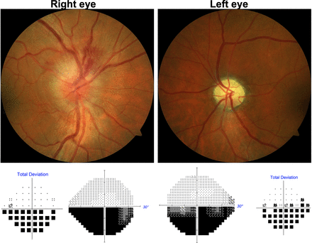 Rapidly progressive non-arteritic anterior ischaemic optic neuropathy ...