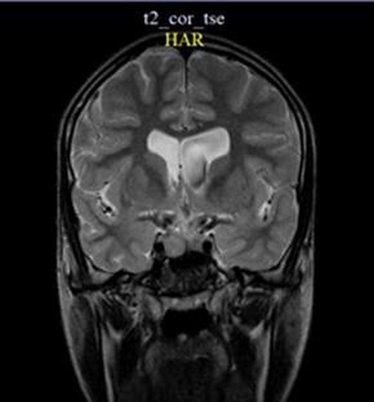 Successful treatment of pituitary gigantism | BMJ Case Reports