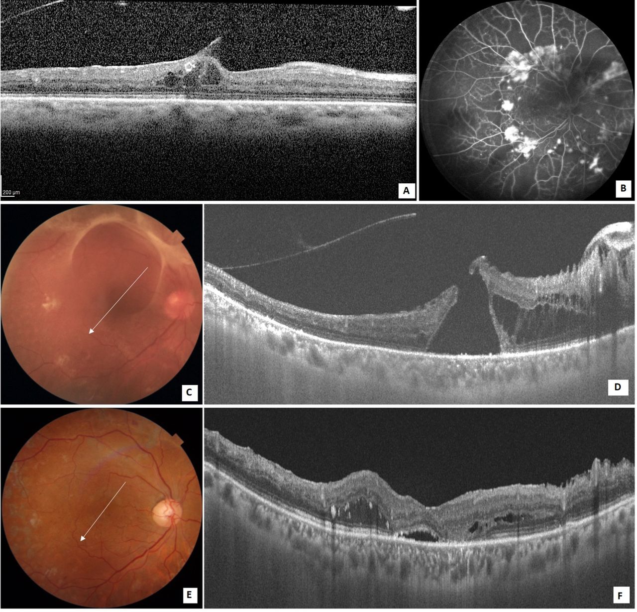 Macular hole formation following panretinal photocoagulation in ...