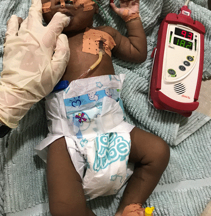 Clinical presentation and improvised management of neonatal ...