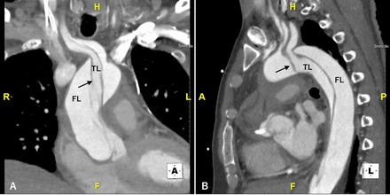 Acute aortic dissection with highly compressed true lumen ...