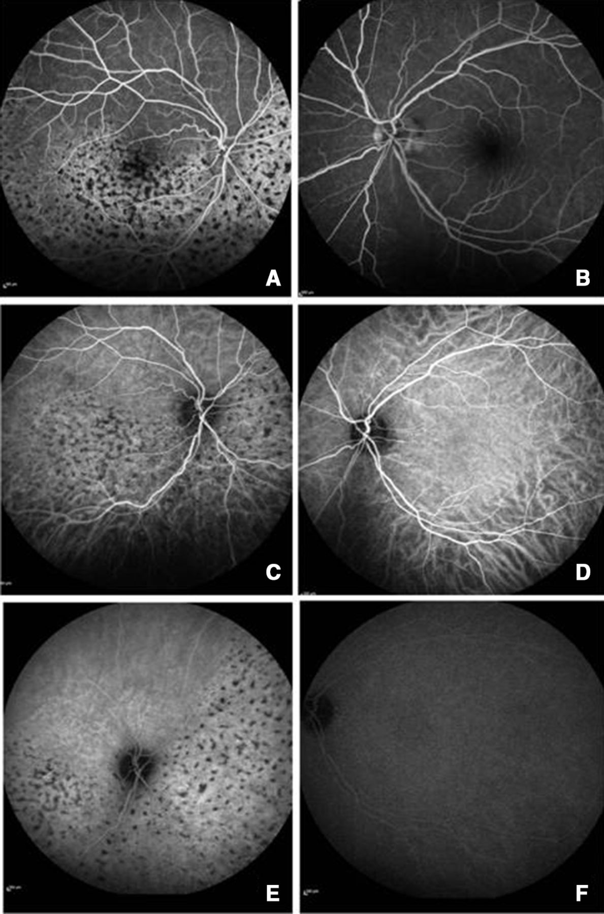 Multimodal imaging to aid in diagnosis of uveal effusion syndrome type ...
