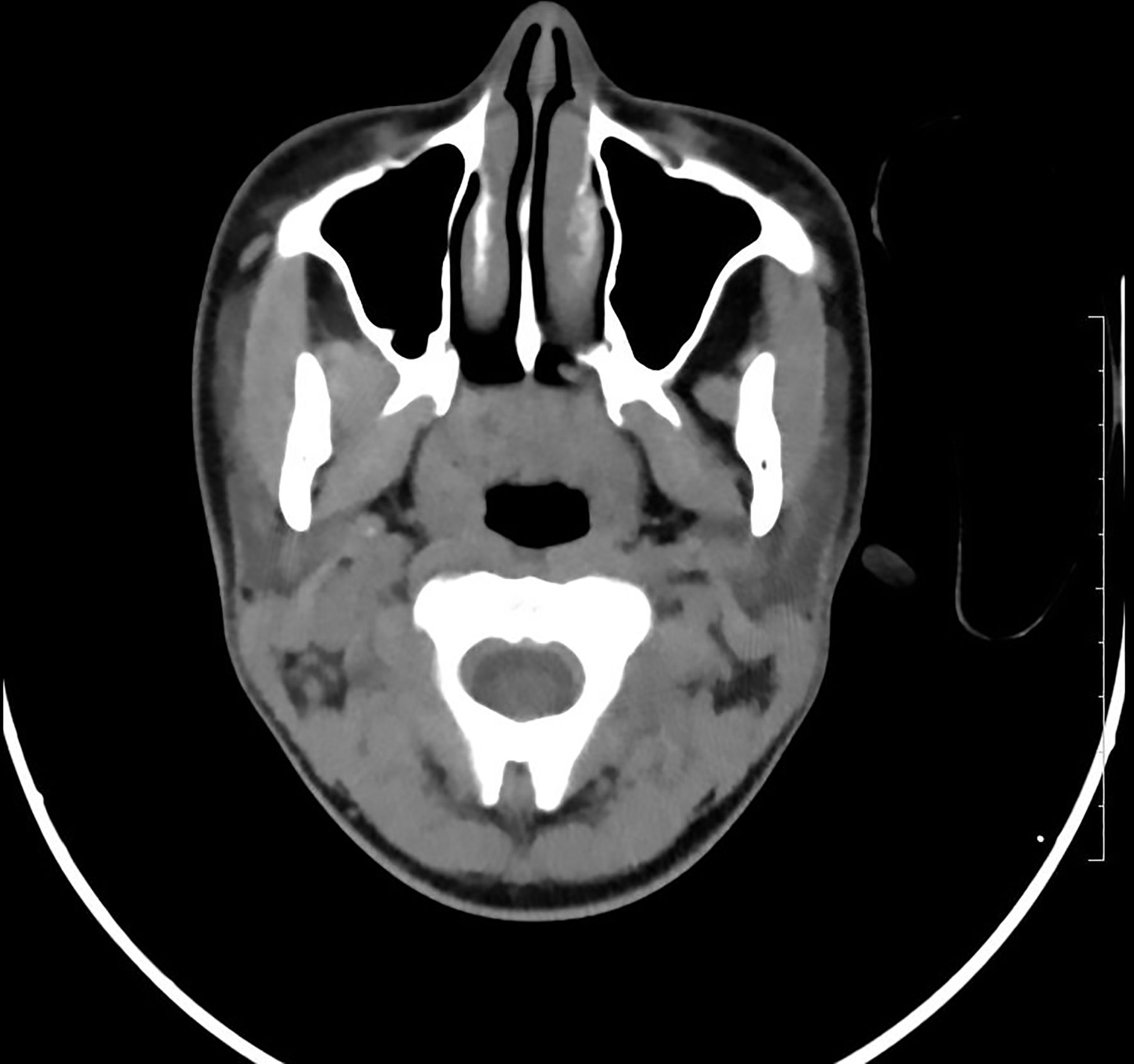 Mucoepidermoid carcinoma of retromolar area: an incidental finding ...