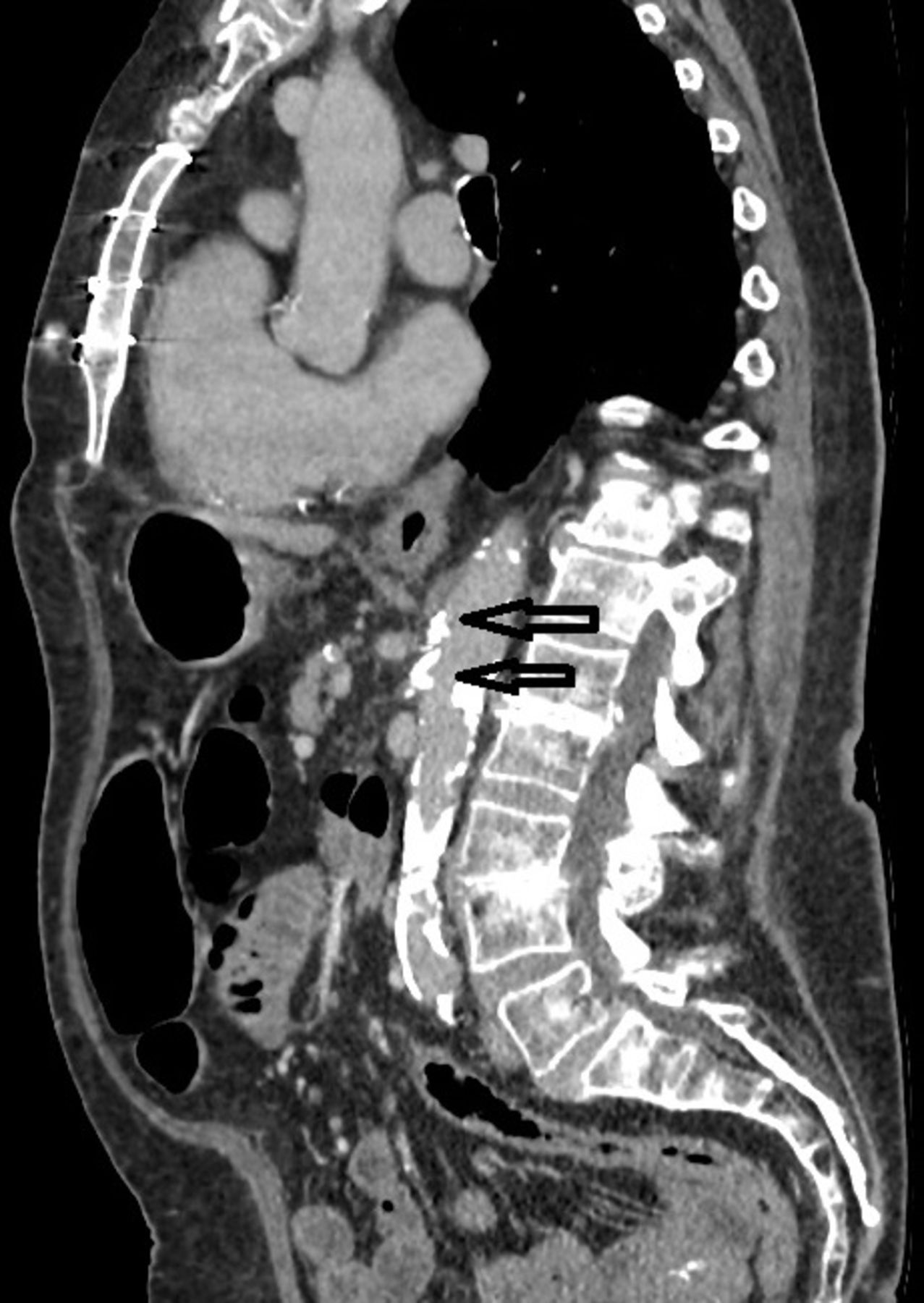 Chronic mesenteric ischaemia presenting as possible large bowl ...