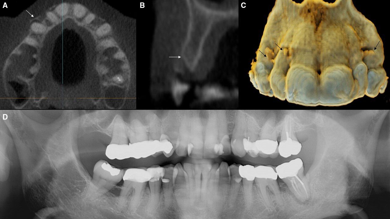Osteonecrosis of the jaw secondary to haematopoietic stem cell ...