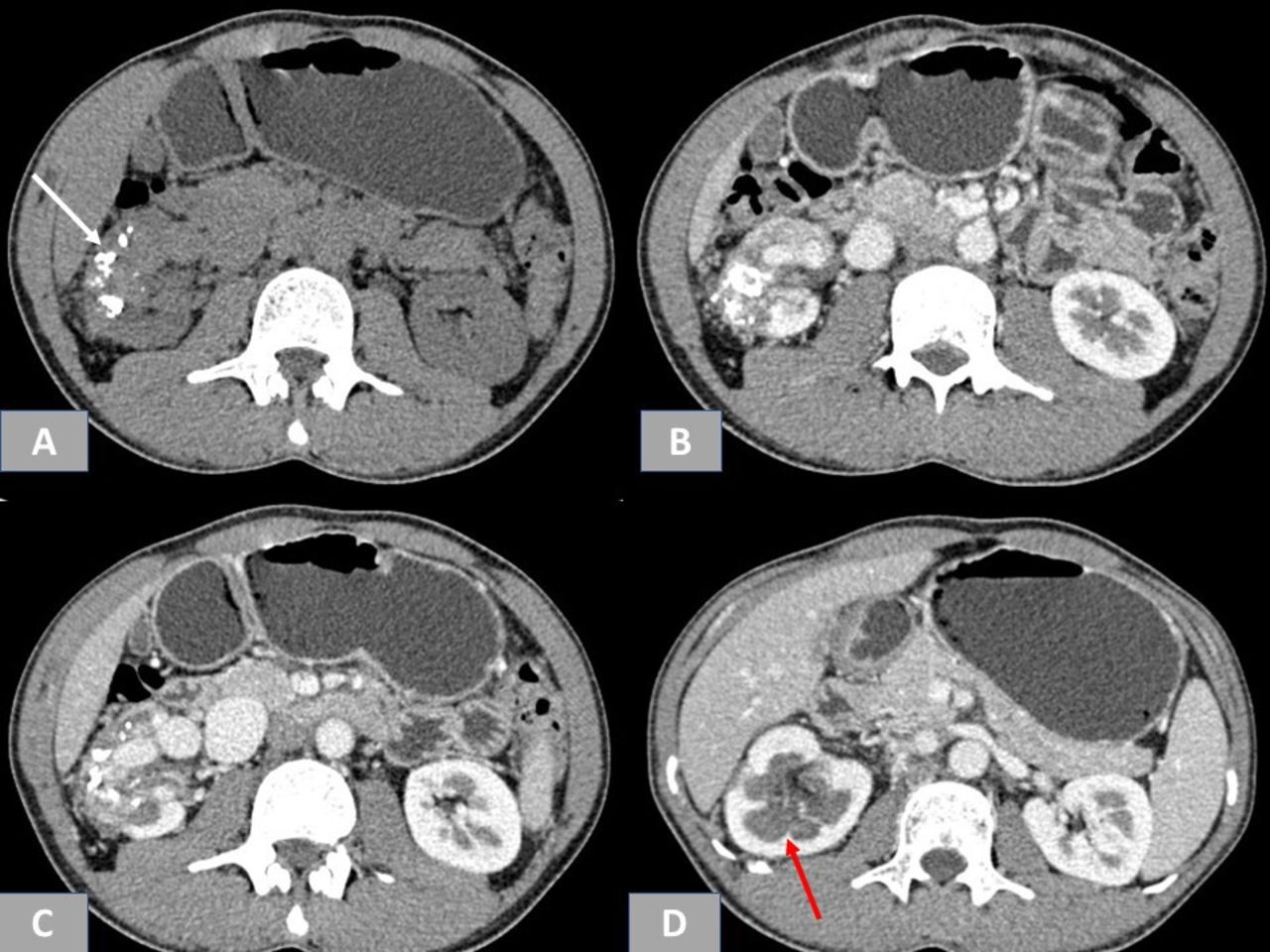 Congenital renal arteriovenous malformation: a rare cause of visible ...
