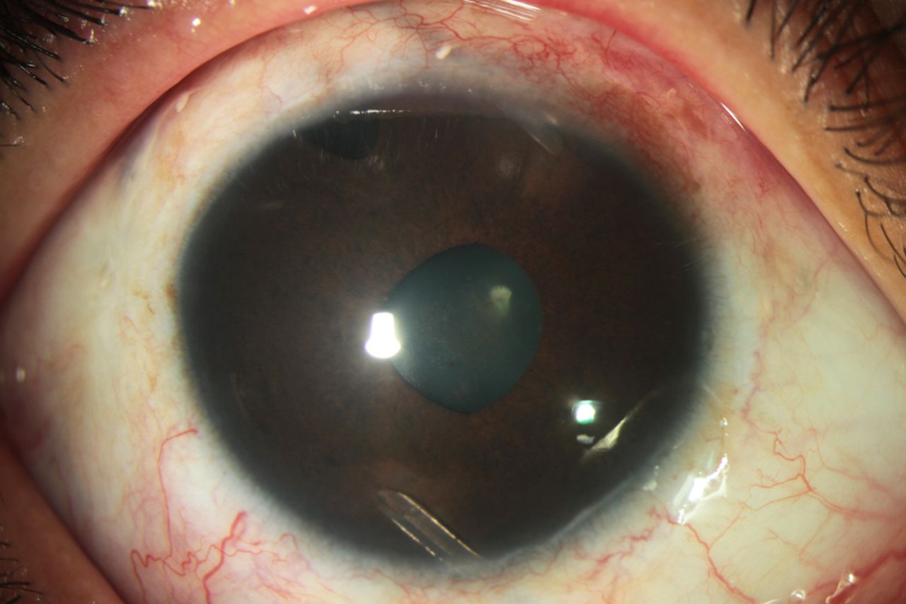 Management of a recurrent encapsulated bleb with a cost-effective non ...