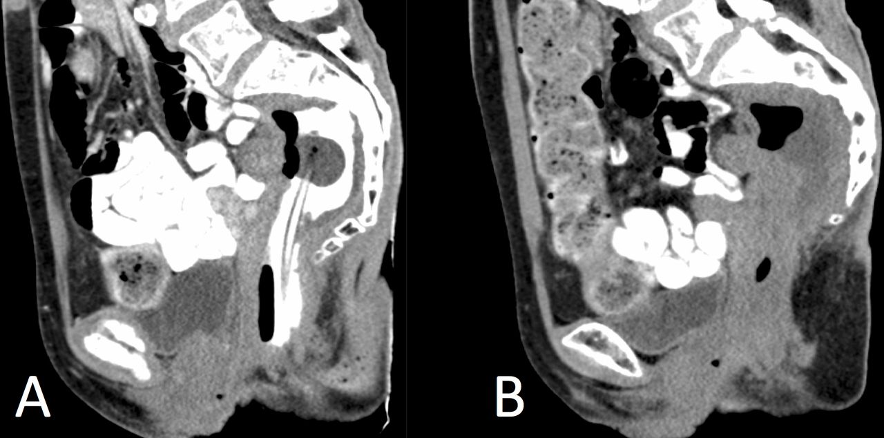 CT images demonstrating the natural progression of locally advanced ...