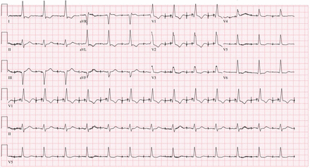 Electrocardiographic spiked-helmet sign in critical non-cardiac illness ...