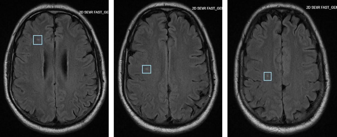 Varicella zoster encephalitis in an immunocompetent patient | BMJ Case ...
