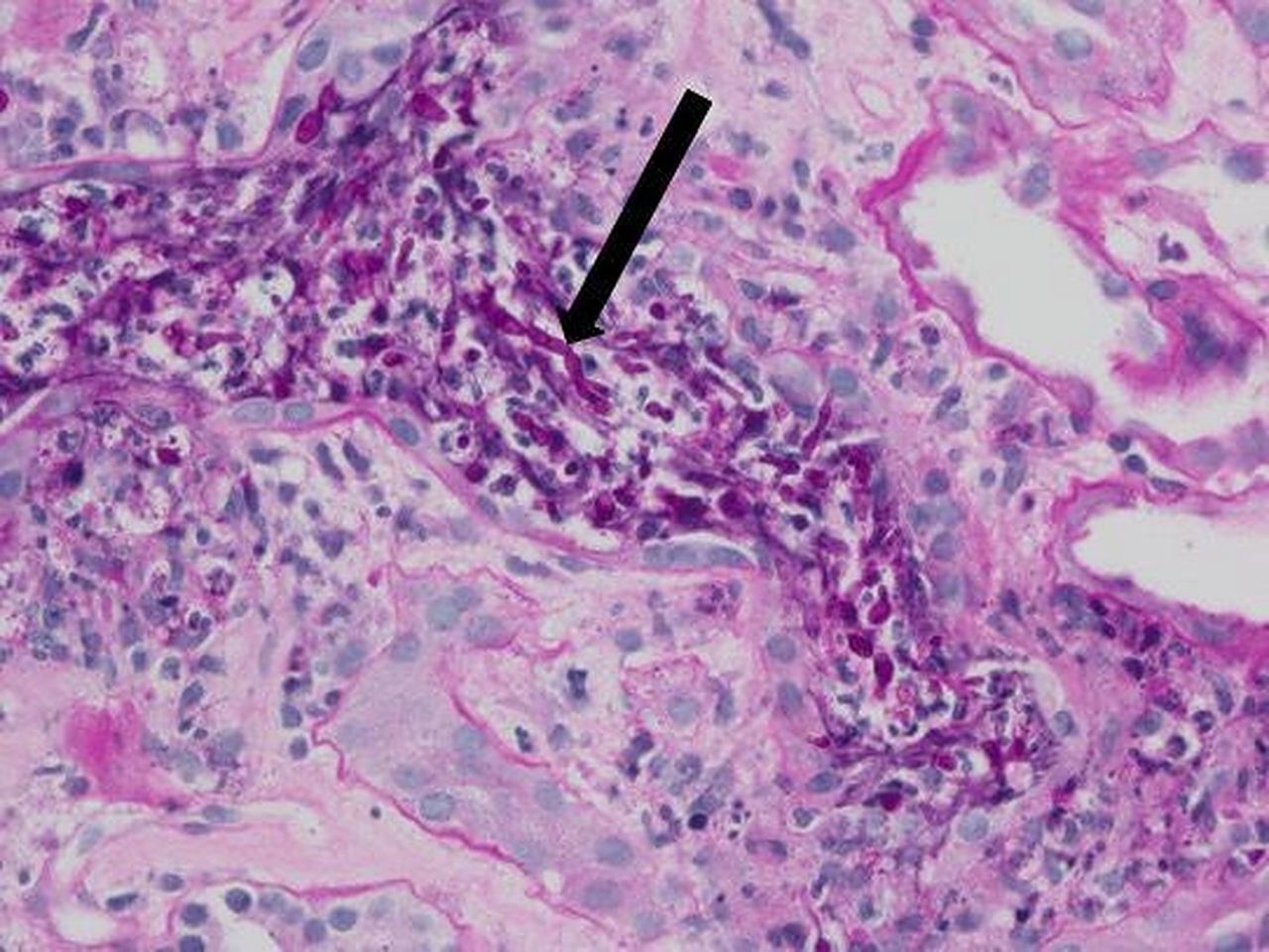 Biopsy-proven fungal pyelonephritis complicating delayed graft function ...