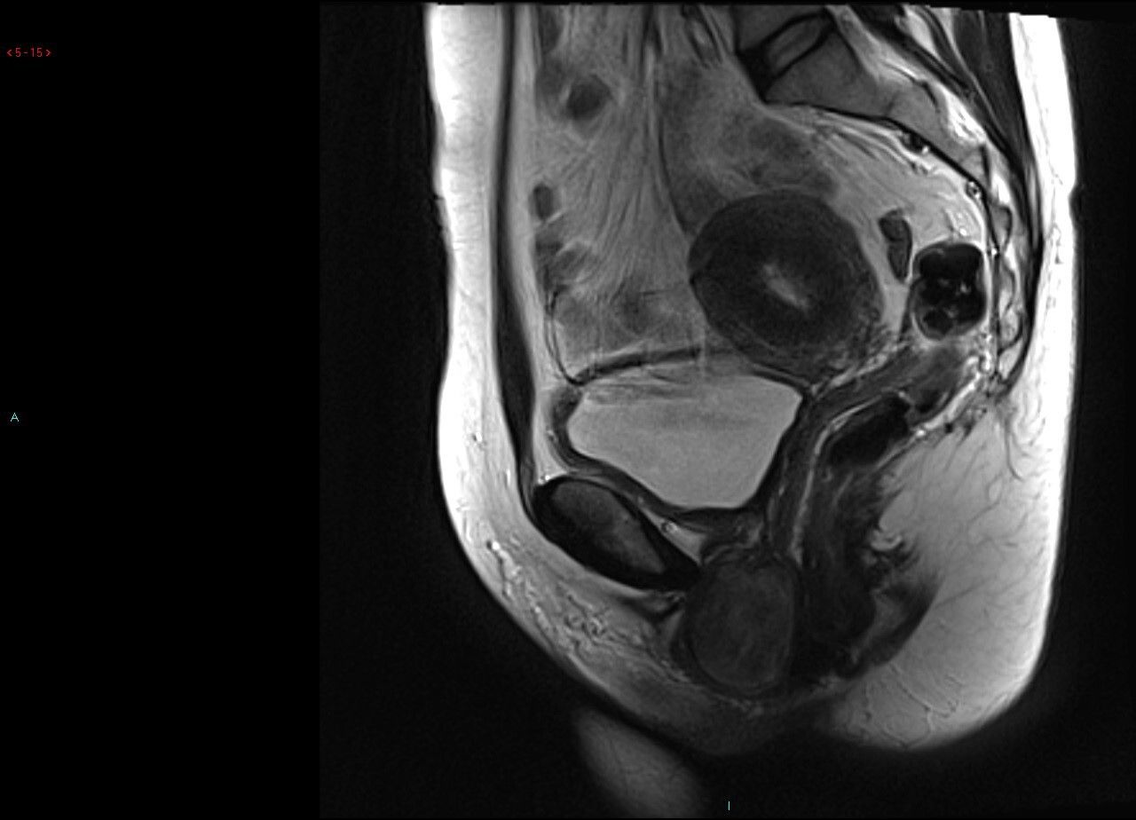 Leiomyoma presenting as an anterior vaginal mass | BMJ Case Reports