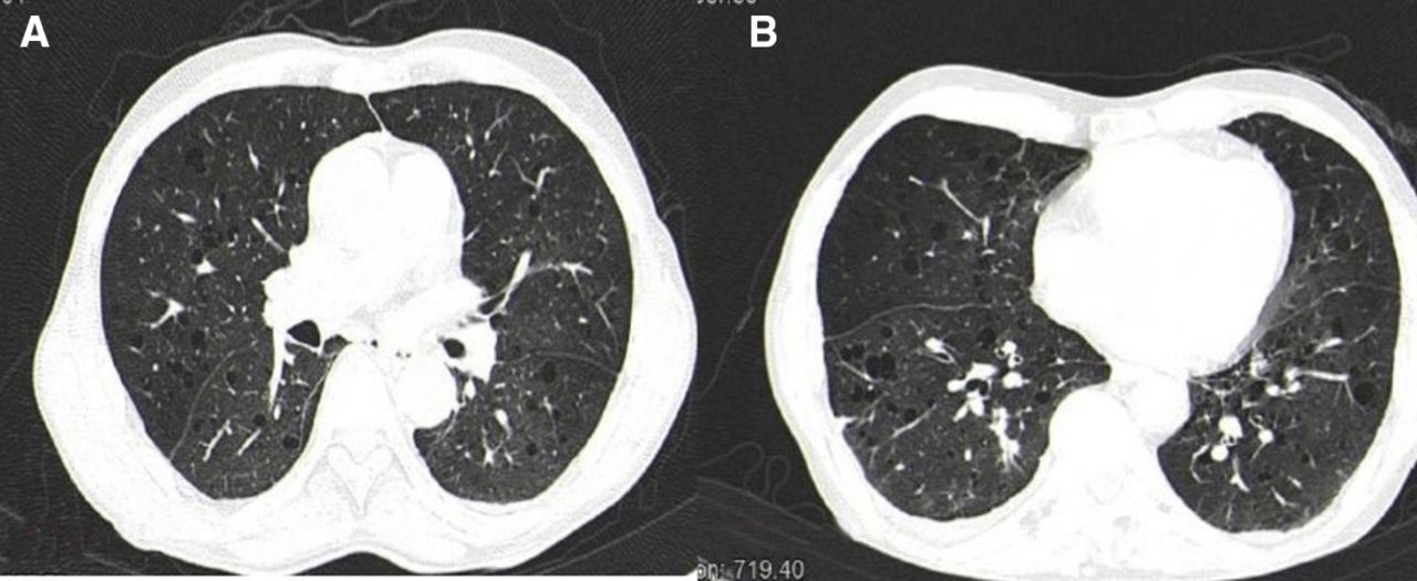 Cystic lung disease lymphangioleiomyomatosis (LAM) in a male patient ...