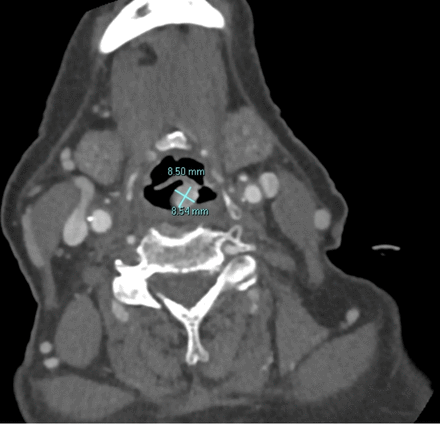 Pyogenic granuloma of the epiglottis: a common lesion in a rare site ...