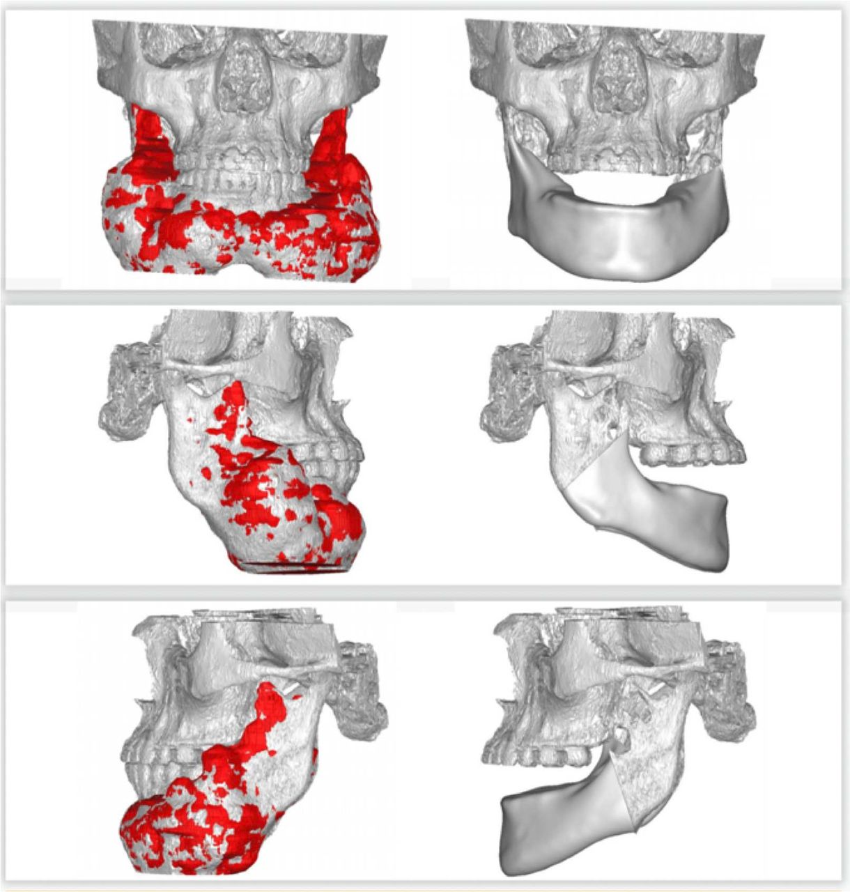 Surgical management of mandibular cherubism in an adolescent ...
