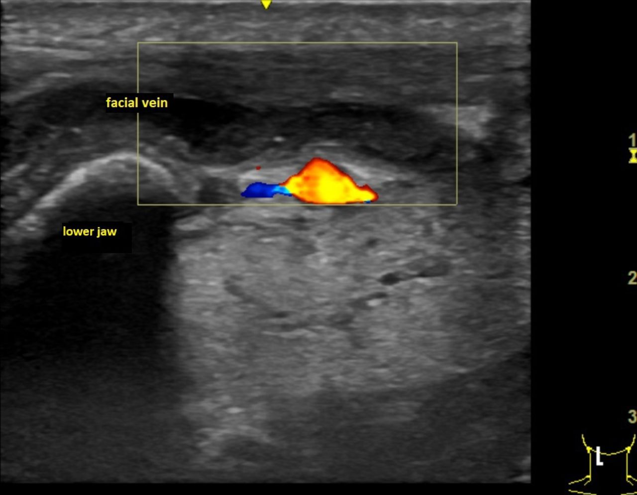 Rare encounter: facial vein thrombosis and thrombophlebitis as a ...
