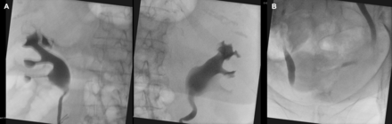 Vaginal pessary: a culprit for intraperitoneal bladder perforation ...