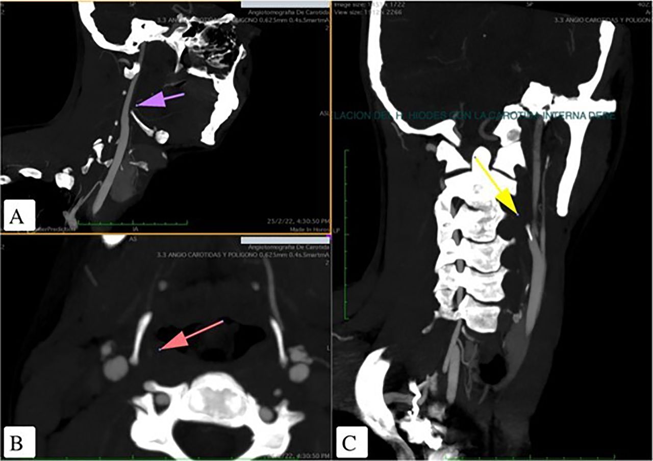 Internal carotid artery dissection associated with an elongated hyoid ...