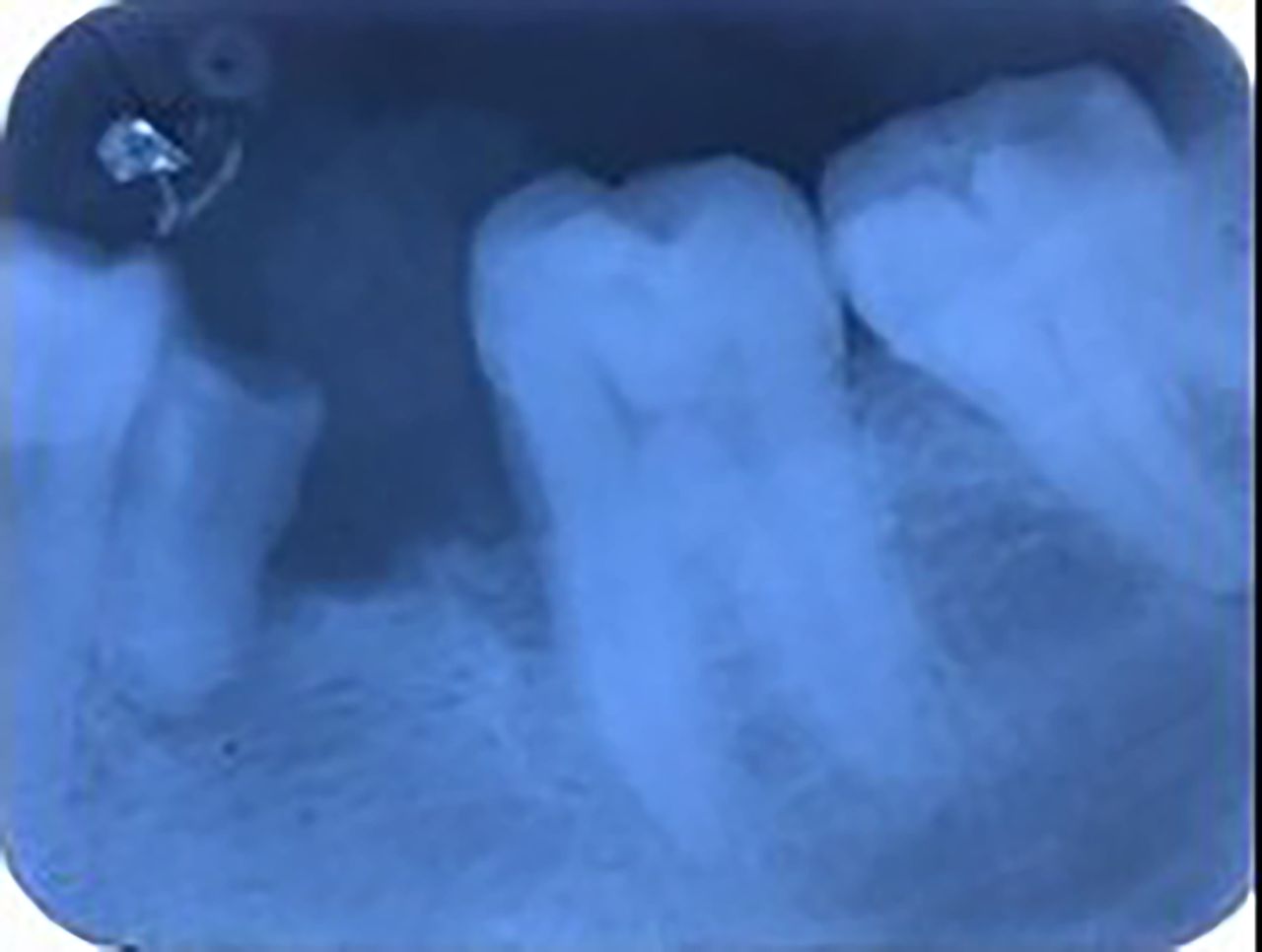 Giant peripheral ossifying fibroma of gingiva: a diagnostic workup ...
