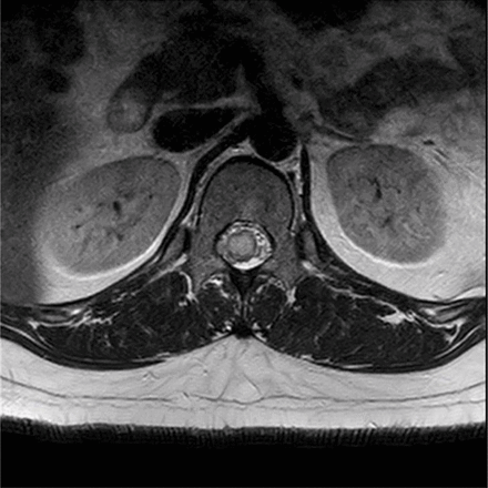 Primary spinal conus medullaris germinoma | BMJ Case Reports