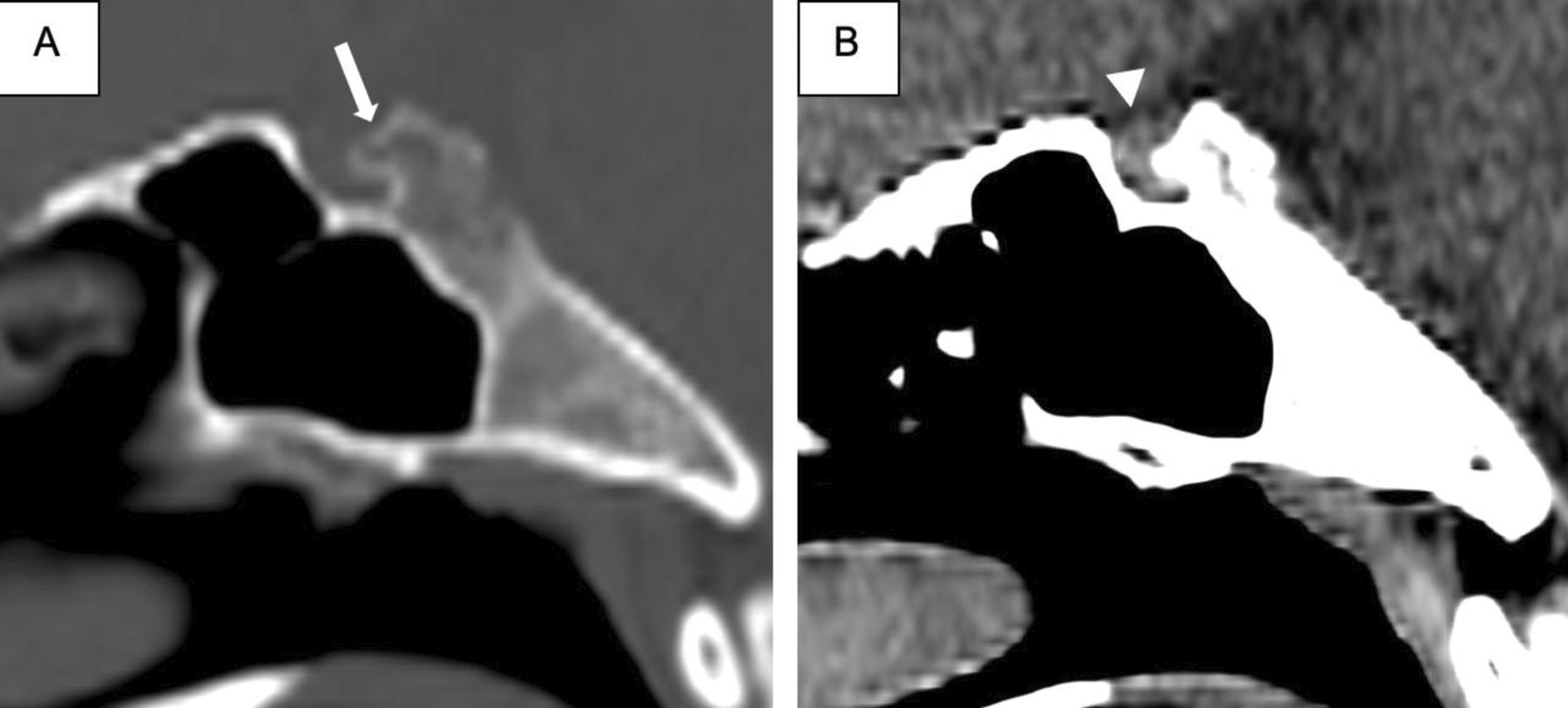 Sellar spine: a rare midline osseous spur | BMJ Case Reports