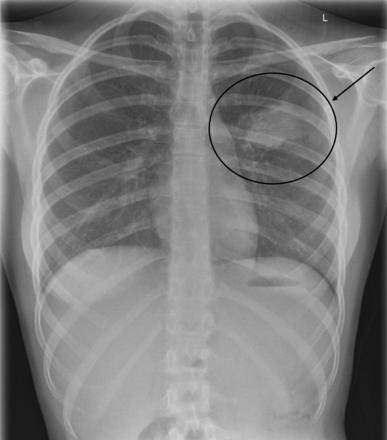 Neisseria meningitidis bacteraemia and lobar pneumonia in a previously ...