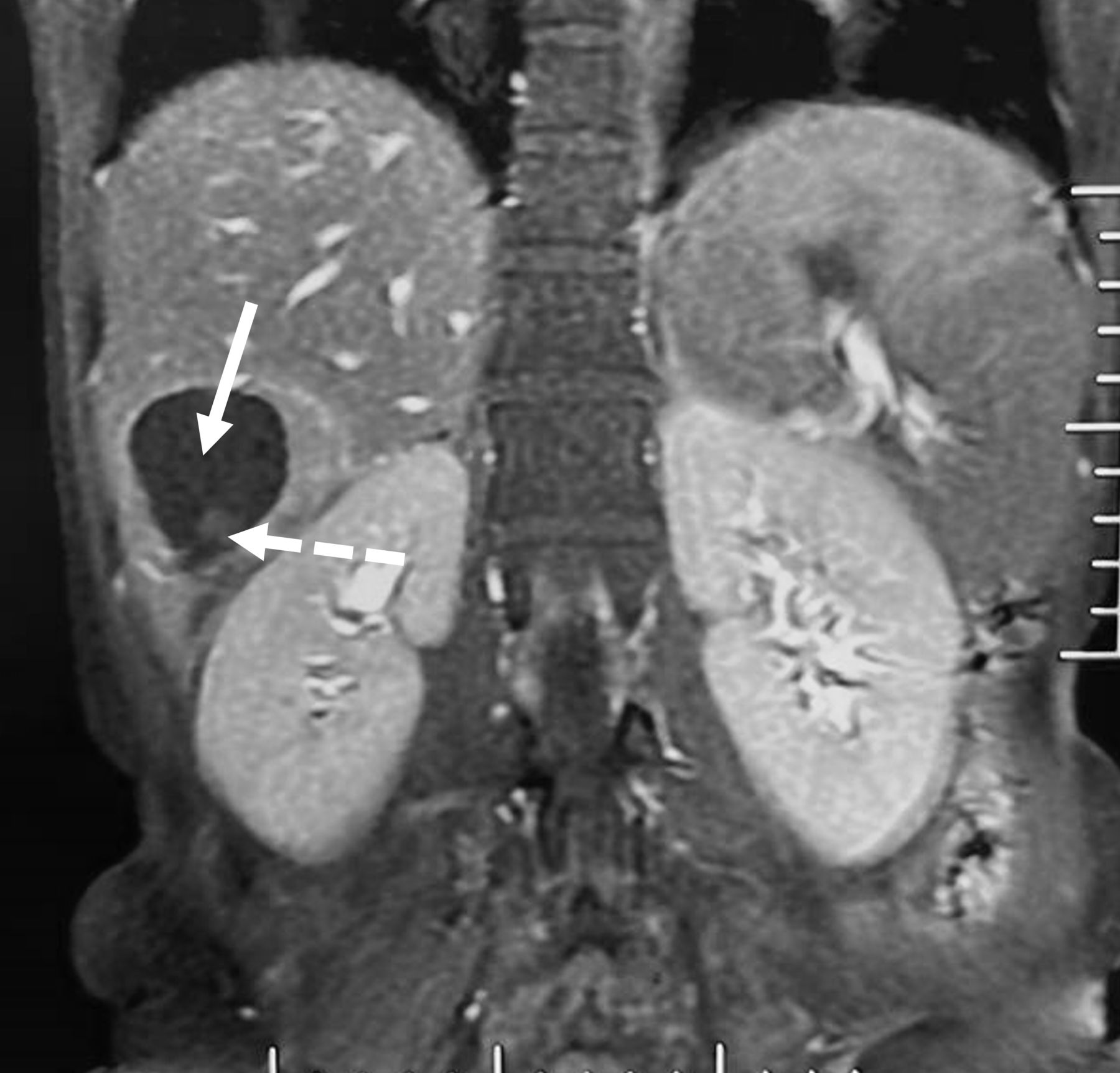 Fate of hepatic ectopic pregnancy 1-year post-treatment: still visible ...