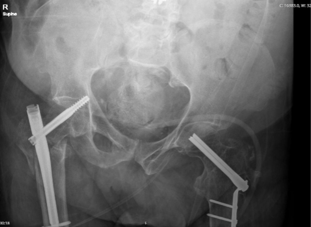 Medial lag screw migration in an intramedullary nail combination | BMJ ...