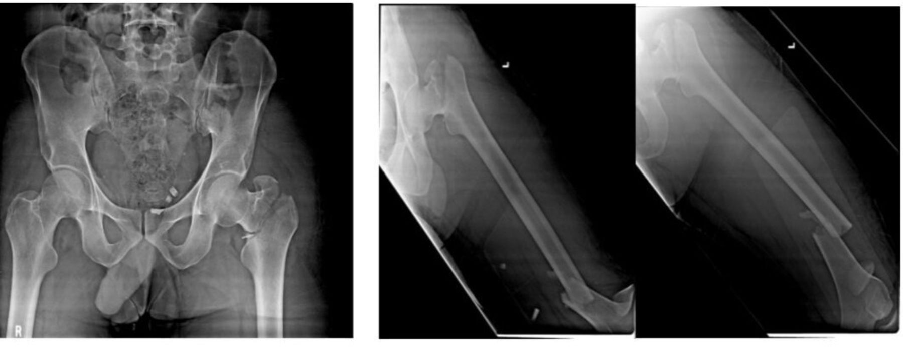 Challenges in ipsilateral intertrochanteric and distal femur shaft ...