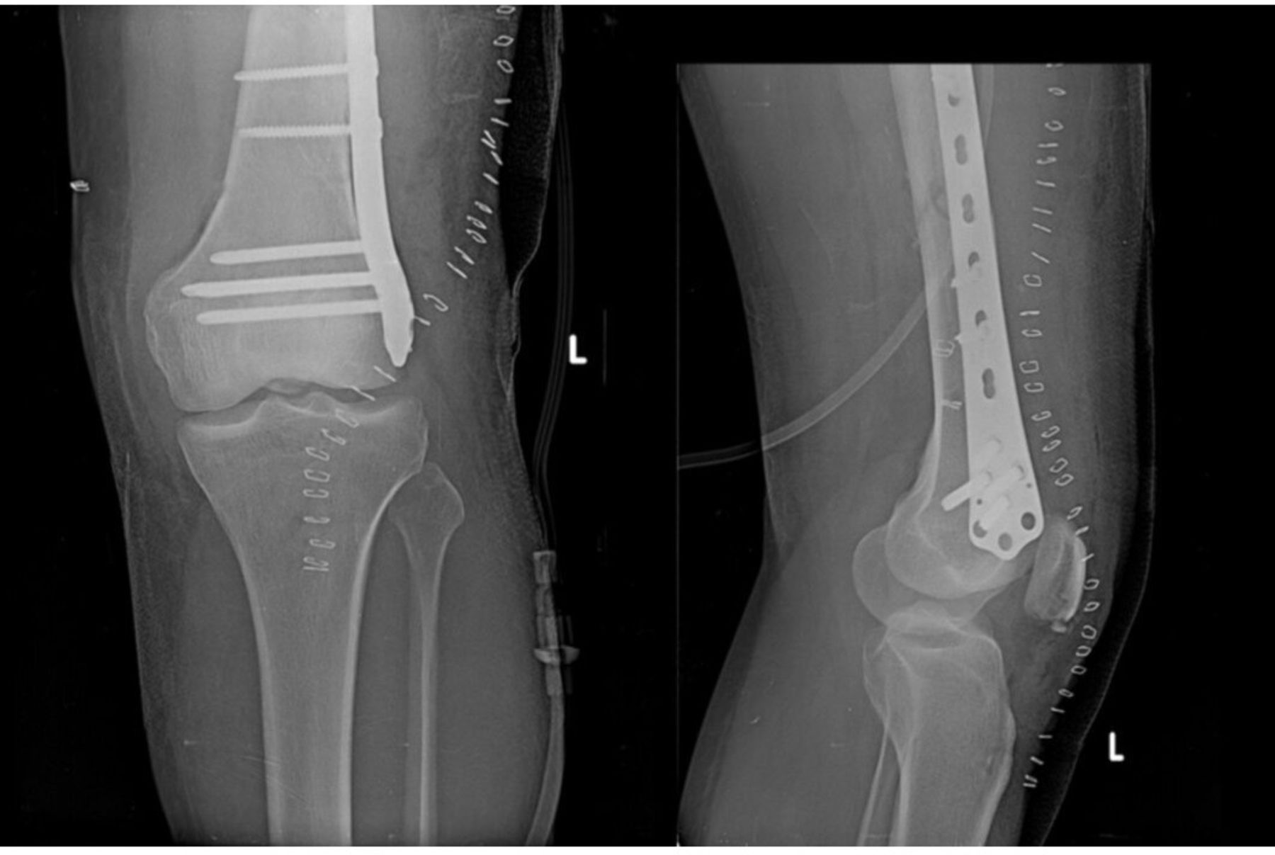 Challenges in ipsilateral intertrochanteric and distal femur shaft ...