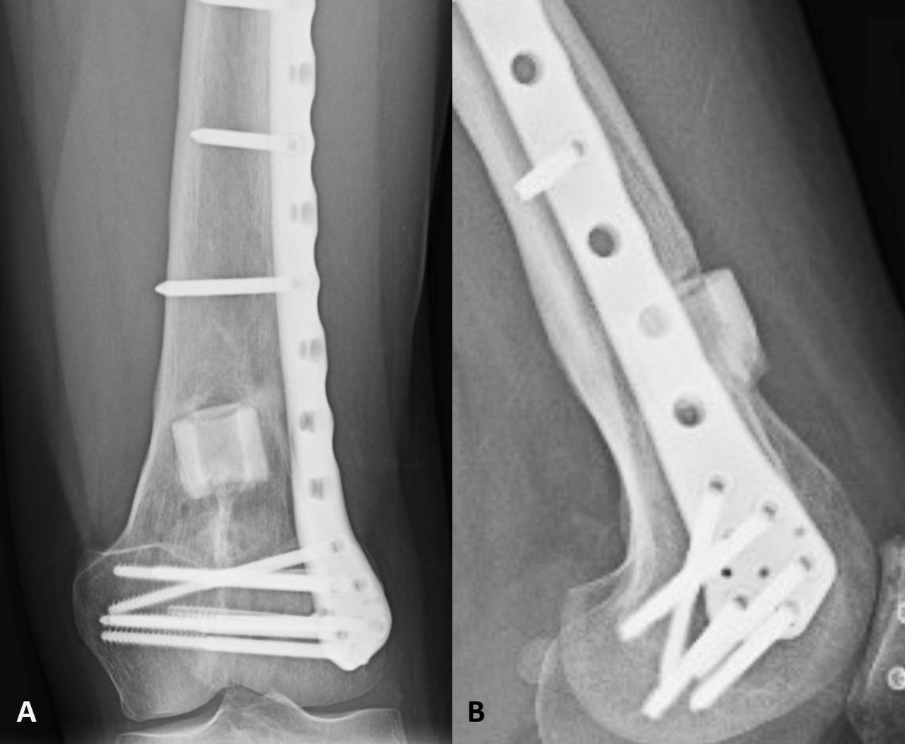 Distal femoral bone defect treatment using an engineered hydroxyapatite ...