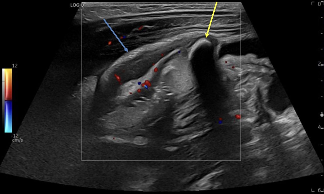 Concomitant ileocolic intussusception and perforated appendicitis in a ...