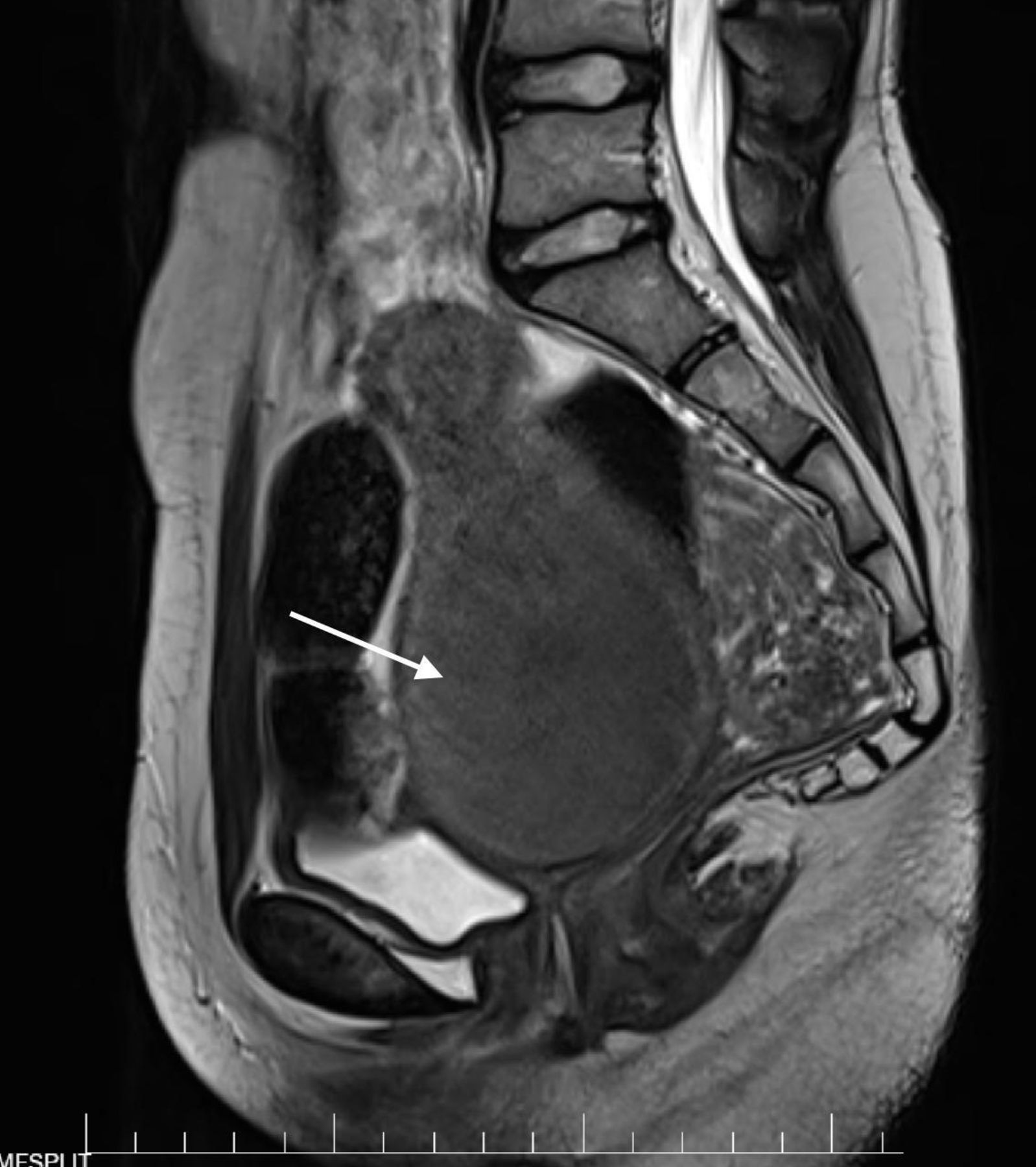 Transverse vaginal septum with recurrent stricture formation in ...