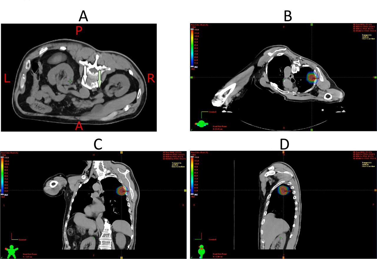 Management of possible idiopathic inferior vena cava compression during ...