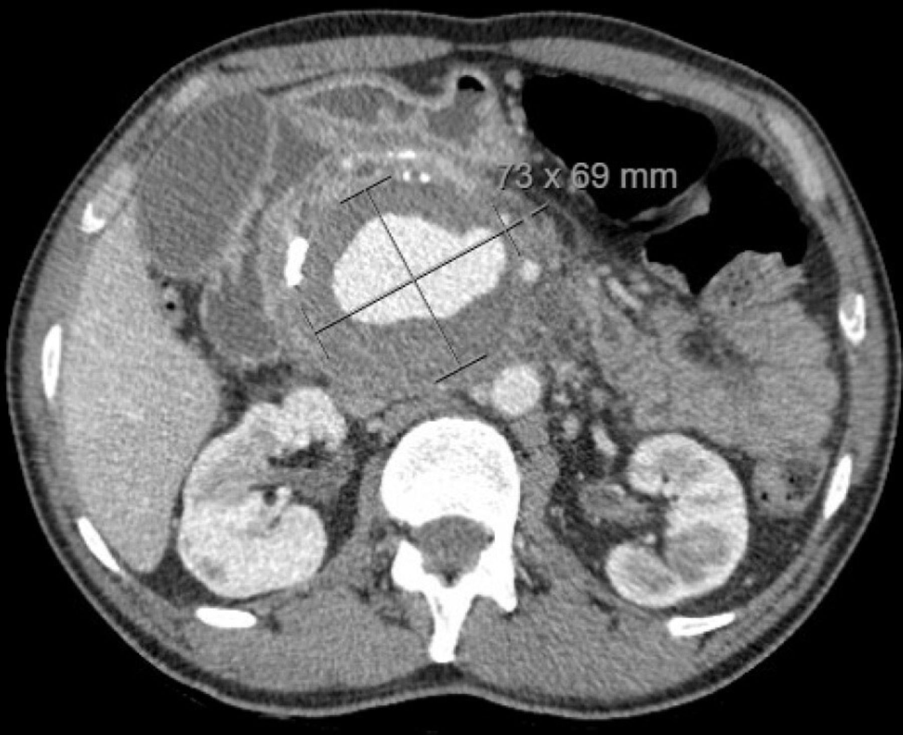 Endovascular management of a rare inferior pancreaticoduodenal artery ...