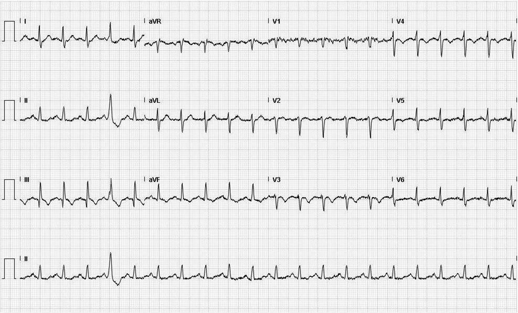 S1Q3T3 pattern leading to early diagnosis of pulmonary embolism | BMJ ...